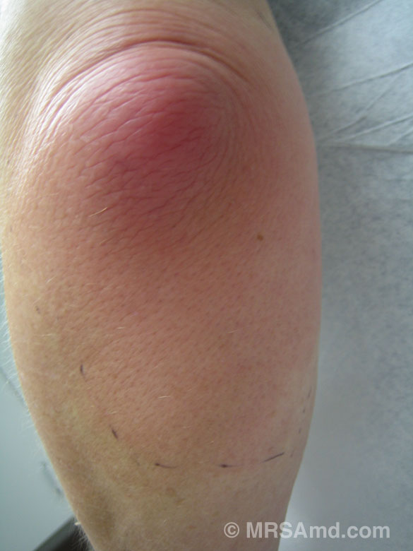 MRSA Pictures Staph Infection Pictures Graphic Images MRSA MD MRSA Pictures Staph Infection Pictures Graphic Images MRSA MD